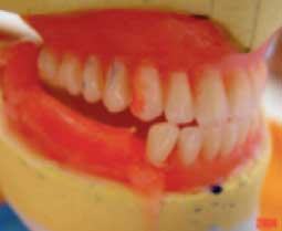 Le guidage antérieur en prothèse adjointe complète | Dossiers du mois